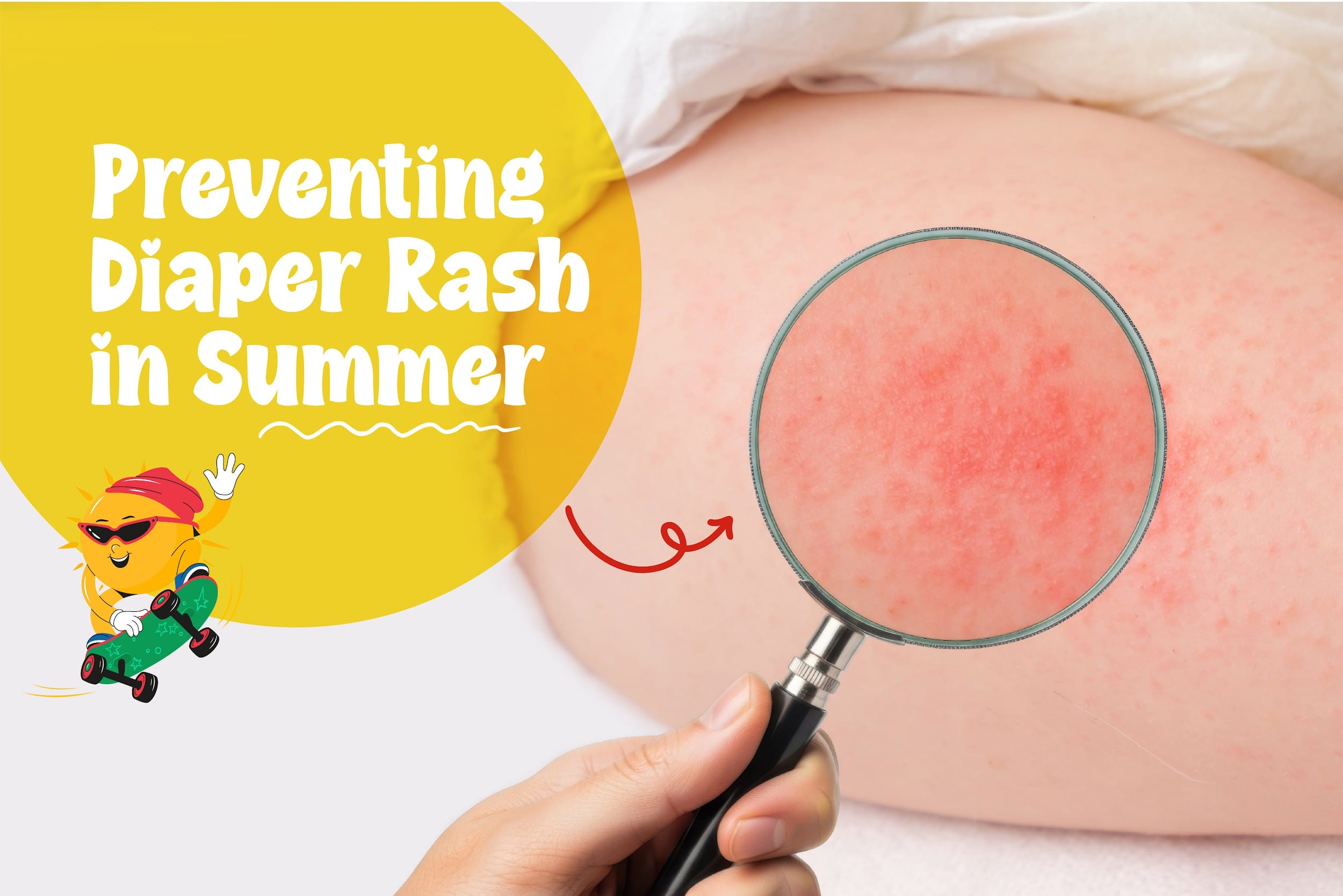 Preventing Diaper Rash in Indian Summer: What Works Best